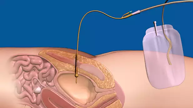 Suprapubic Catheter Surgery Genitourinary: Urinary Catheters And