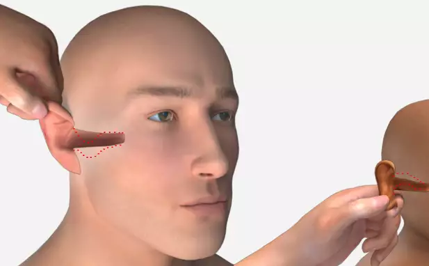 Irrigate the Ear and Instill Ear Medication