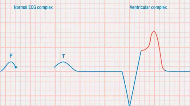Electrocardiogram (ECG) 12-Lead